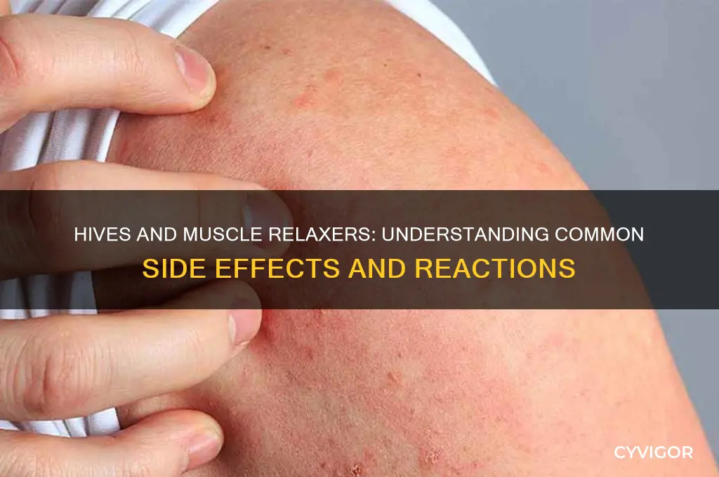 Hives And Muscle Relaxers: Understanding Common Side Effects And ...