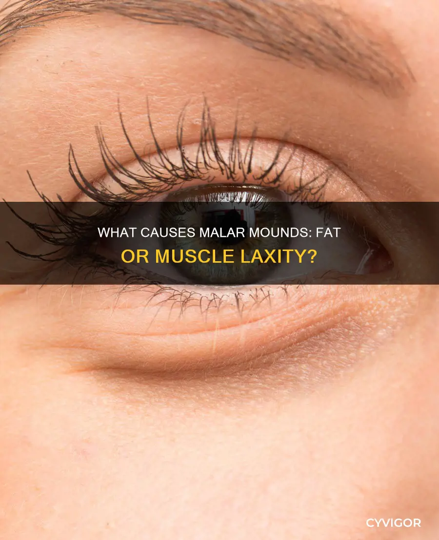 What Causes Malar Mounds: Fat Or Muscle Laxity? | CyVigor
