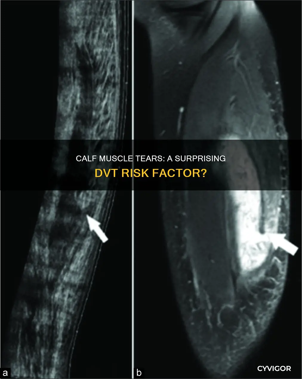 Calf Muscle Tears: A Surprising Dvt Risk Factor? | CyVigor