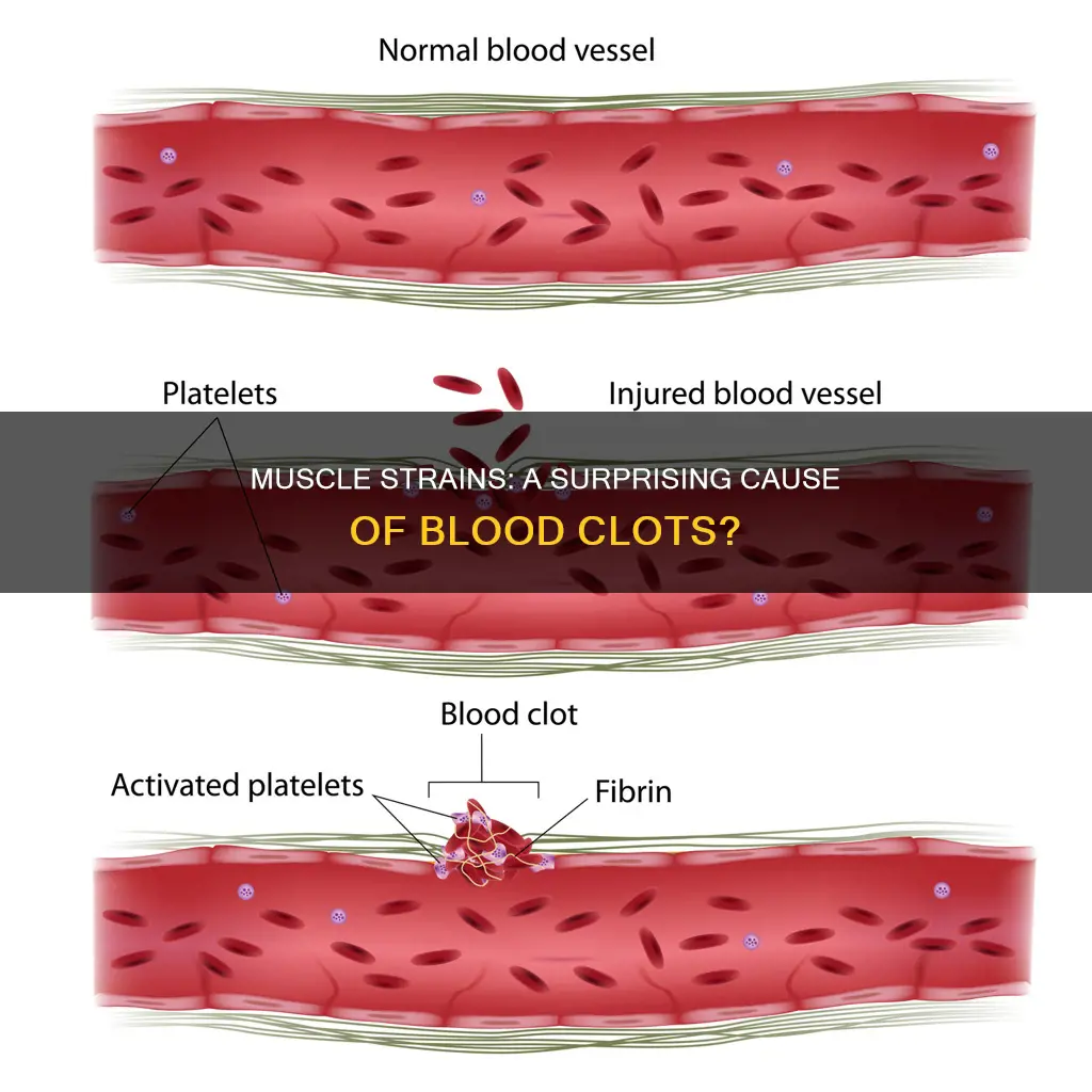 Muscle Strains: A Surprising Cause Of Blood Clots? | CyVigor