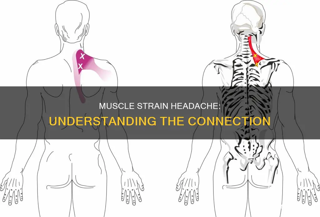 Muscle Strain Headache: Understanding The Connection | CyVigor