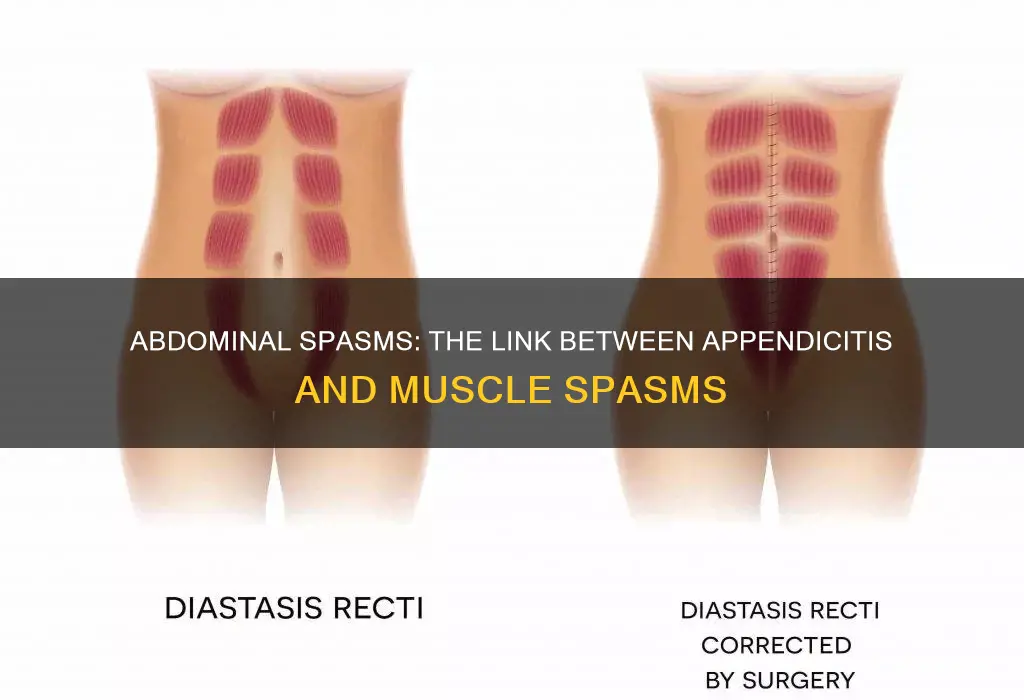 Abdominal Spasms: The Link Between Appendicitis And Muscle Spasms | CyVigor