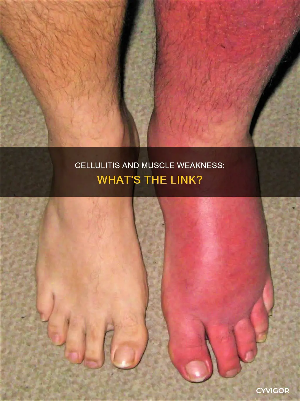 Cellulitis And Muscle Weakness: What's The Link? | CyVigor