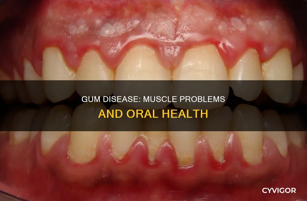 Gum Disease: Muscle Problems And Oral Health | CyVigor