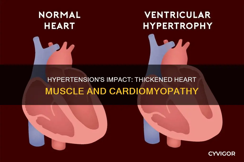 Hypertension's Impact: Thickened Heart Muscle And Cardiomyopathy | CyVigor