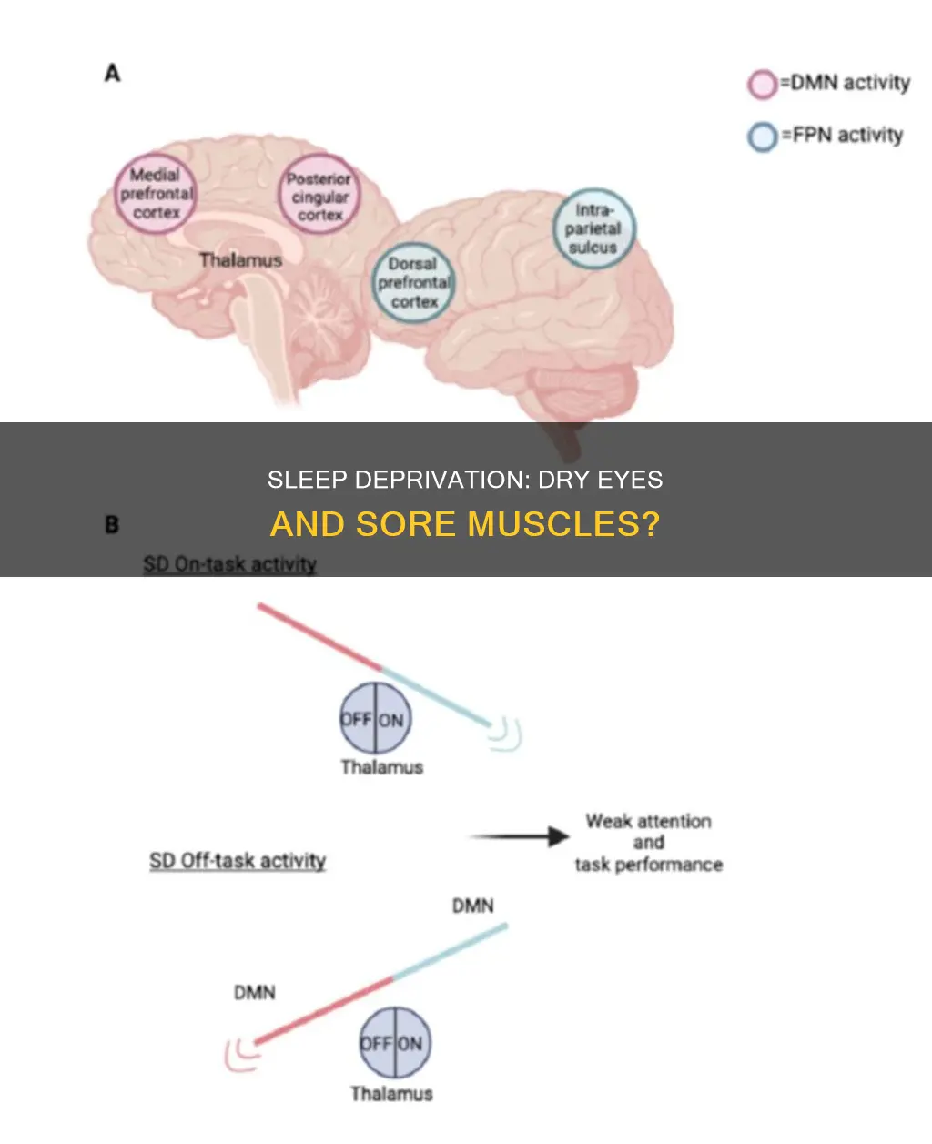 Sleep Deprivation: Dry Eyes And Sore Muscles? | CyVigor