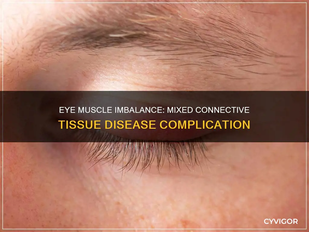 Eye Muscle Imbalance: Mixed Connective Tissue Disease Complication ...