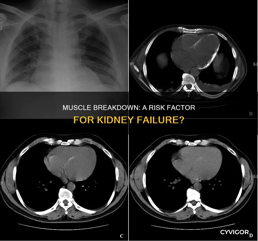 Muscle Breakdown: A Risk Factor For Kidney Failure? | CyVigor