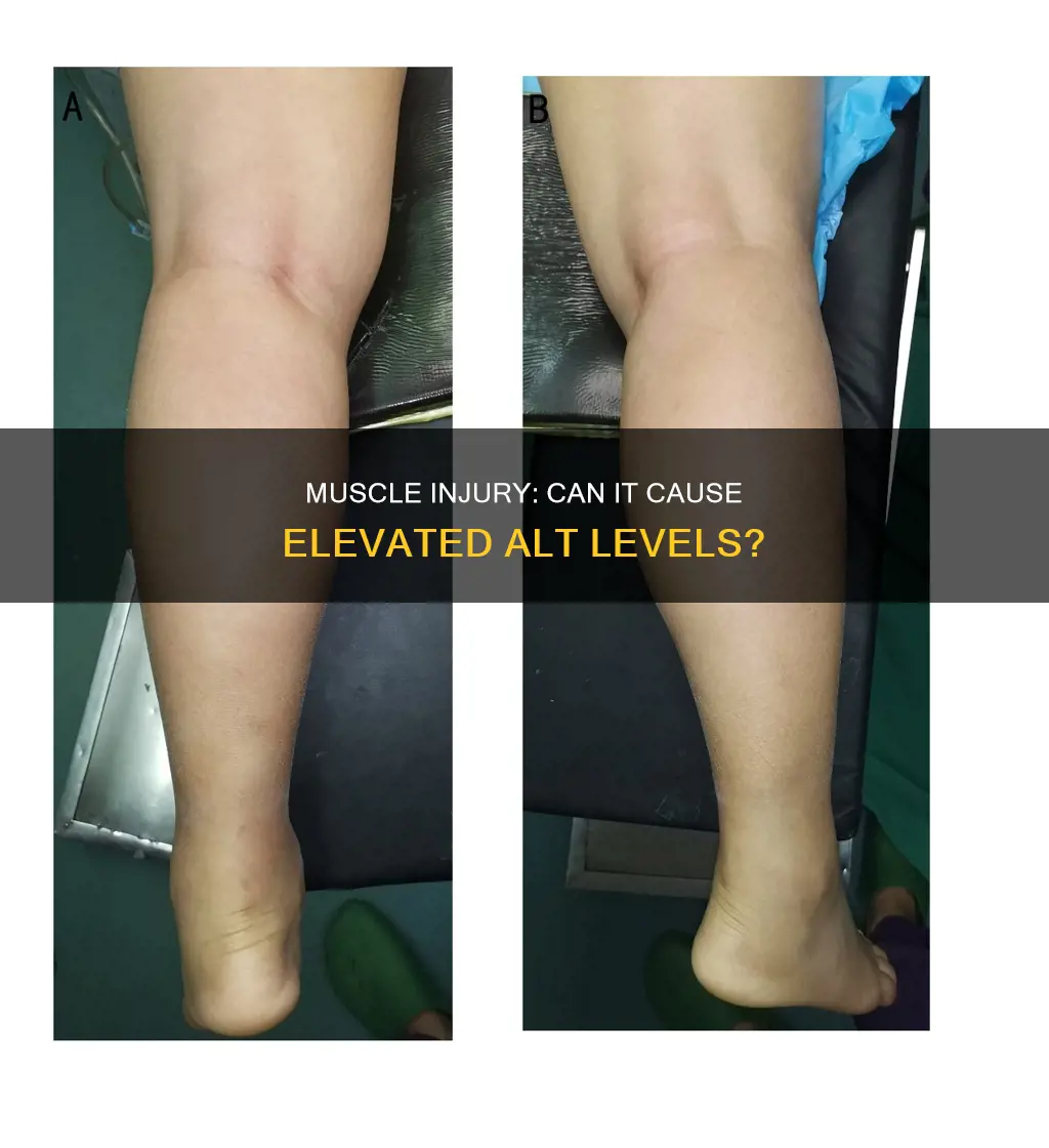 Muscle Injury: Can It Cause Elevated Alt Levels? | CyVigor