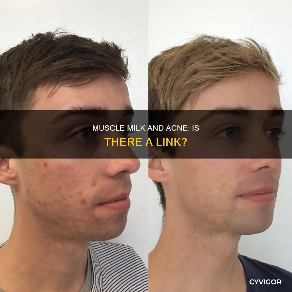Muscle Milk And Acne: Is There A Link? | CyVigor