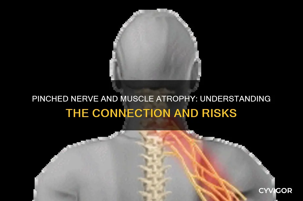 Pinched Nerve And Muscle Atrophy: Understanding The Connection And ...