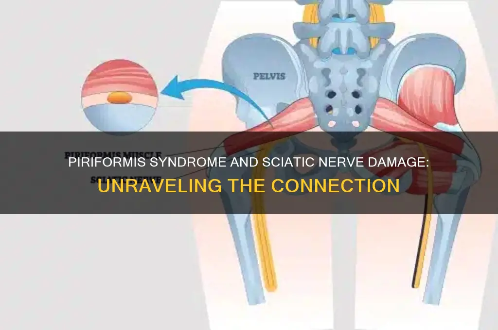 Piriformis Syndrome And Sciatic Nerve Damage: Unraveling The Connection ...