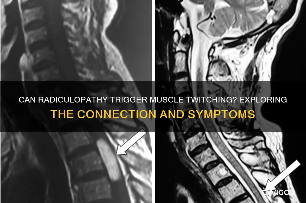 Can Radiculopathy Trigger Muscle Twitching? Exploring The Connection ...