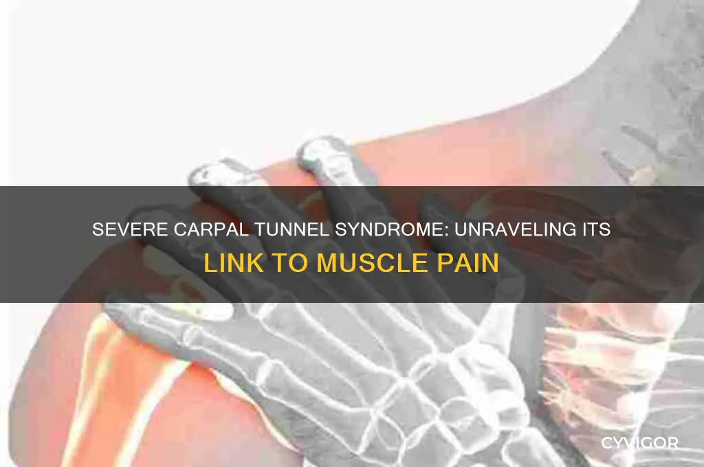 Severe Carpal Tunnel Syndrome: Unraveling Its Link To Muscle Pain | CyVigor