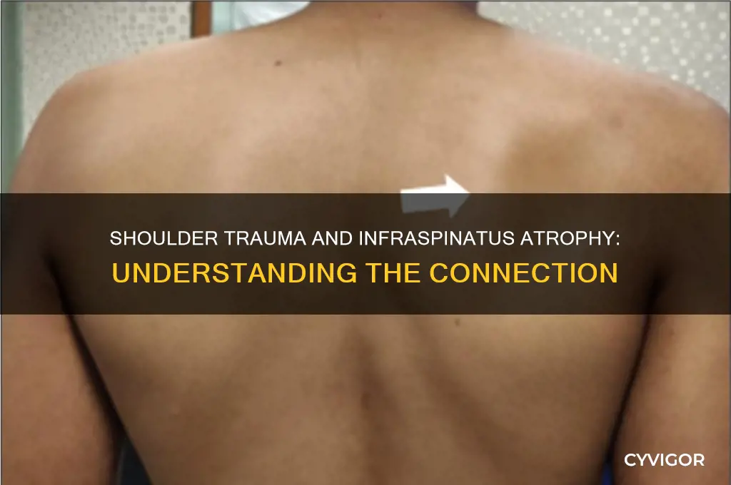 Shoulder Trauma And Infraspinatus Atrophy: Understanding The Connection ...