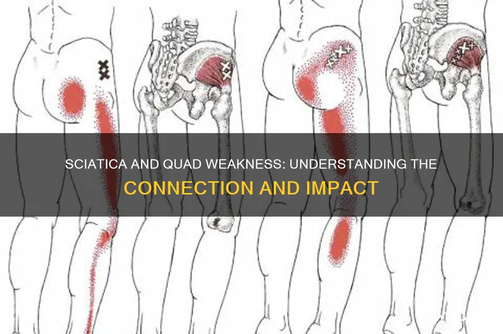 Sciatica And Quad Weakness: Understanding The Connection And Impact ...