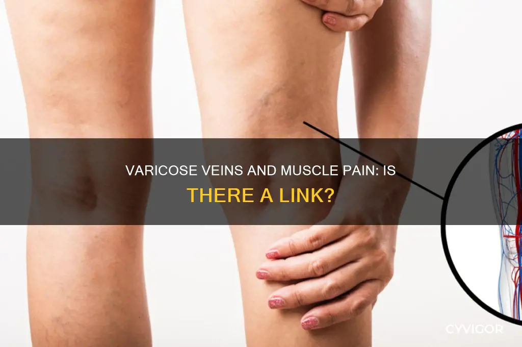 Varicose Veins And Muscle Pain: Is There A Link? | CyVigor