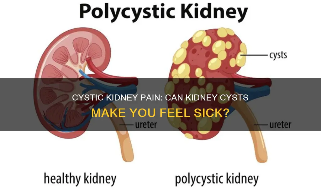 Cystic Kidney Pain: Can Kidney Cysts Make You Feel Sick? | CyVigor