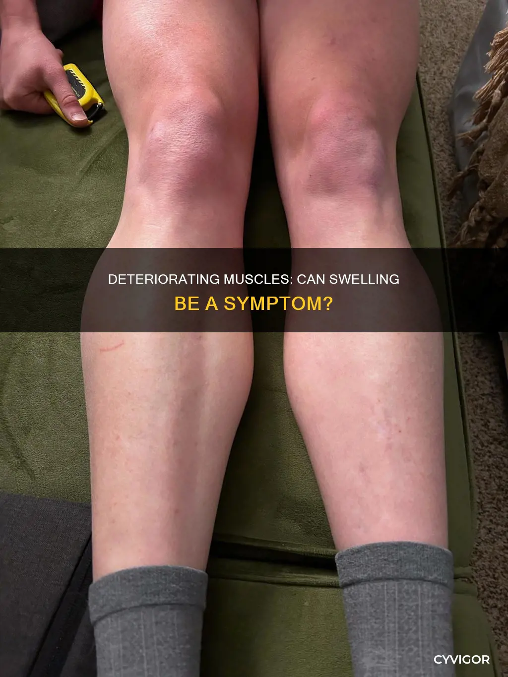 Deteriorating Muscles: Can Swelling Be A Symptom? | CyVigor