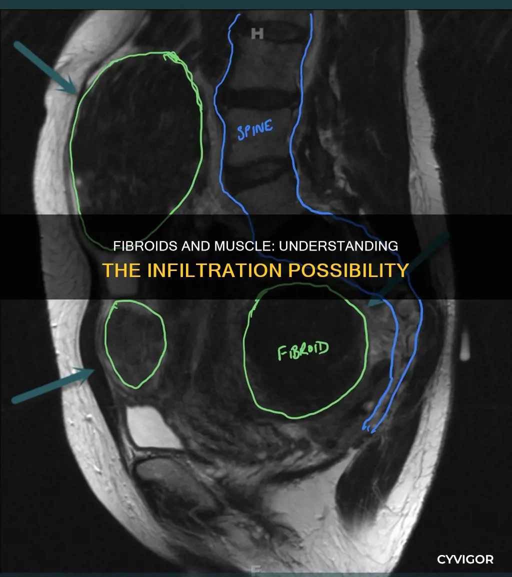 Fibroids And Muscle: Understanding The Infiltration Possibility | CyVigor