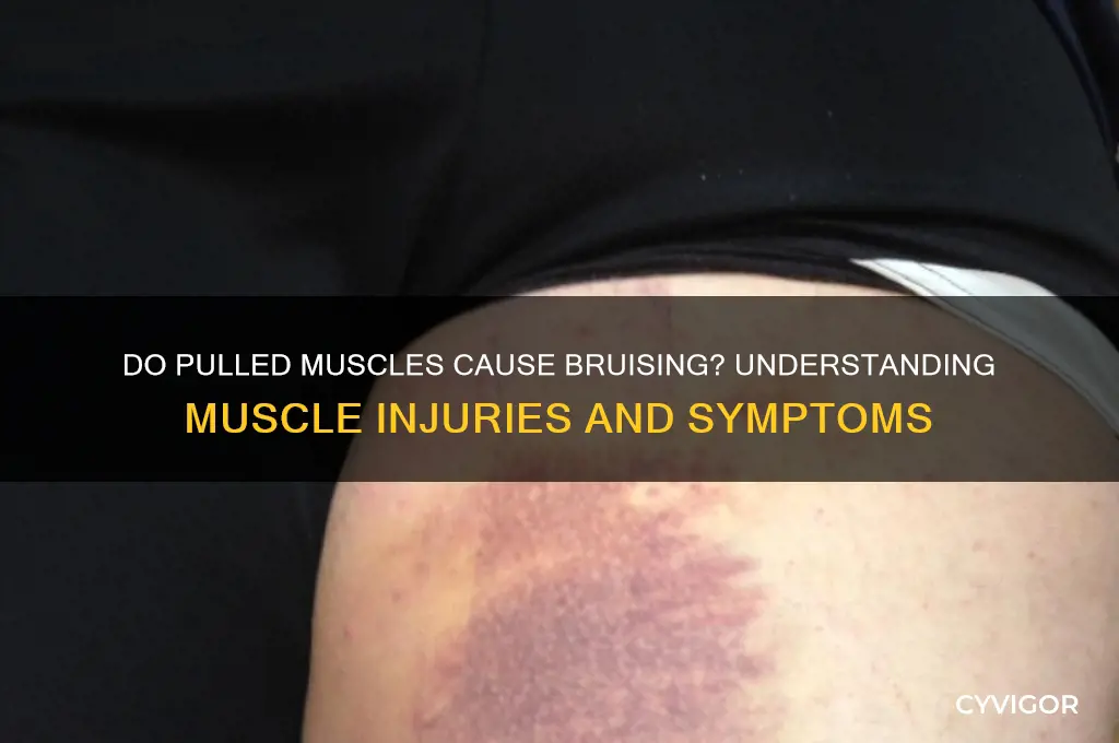 Do Pulled Muscles Cause Bruising? Understanding Muscle Injuries And ...