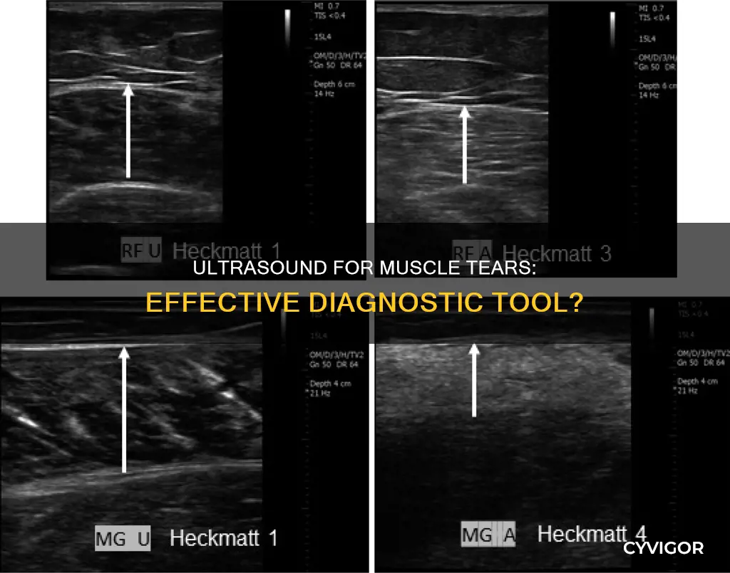 Ultrasound For Muscle Tears: Effective Diagnostic Tool? | CyVigor