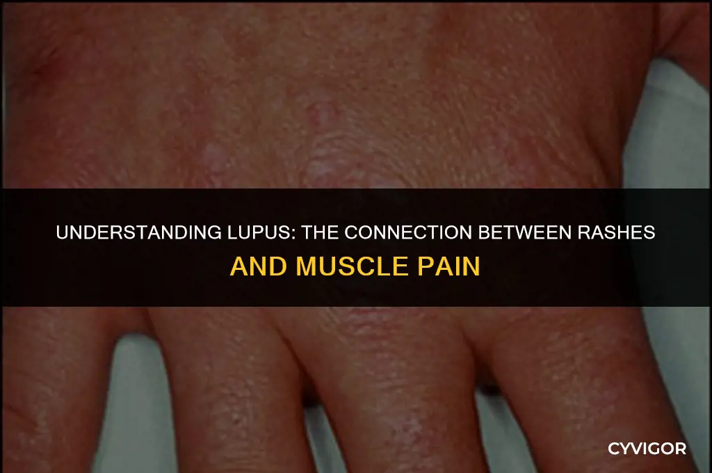 Understanding Lupus: The Connection Between Rashes And Muscle Pain ...