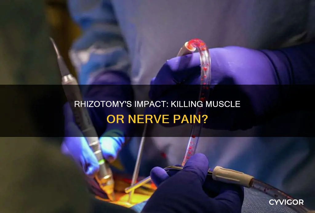Rhizotomy's Impact: Killing Muscle Or Nerve Pain? | CyVigor