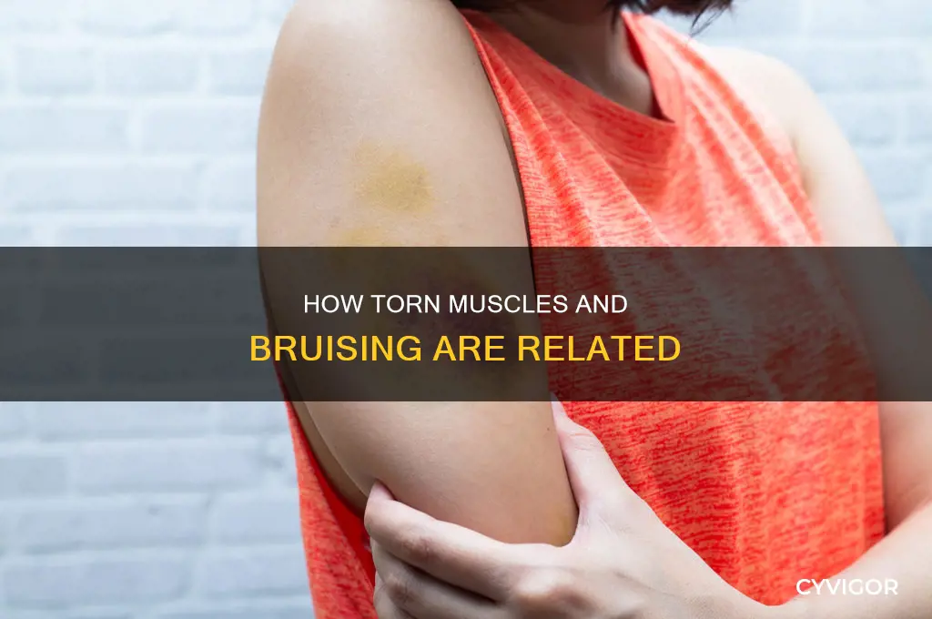 How Torn Muscles And Bruising Are Related | CyVigor