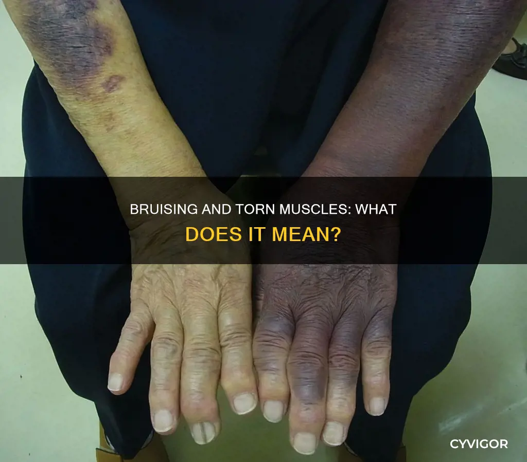 Bruising And Torn Muscles: What Does It Mean? | CyVigor