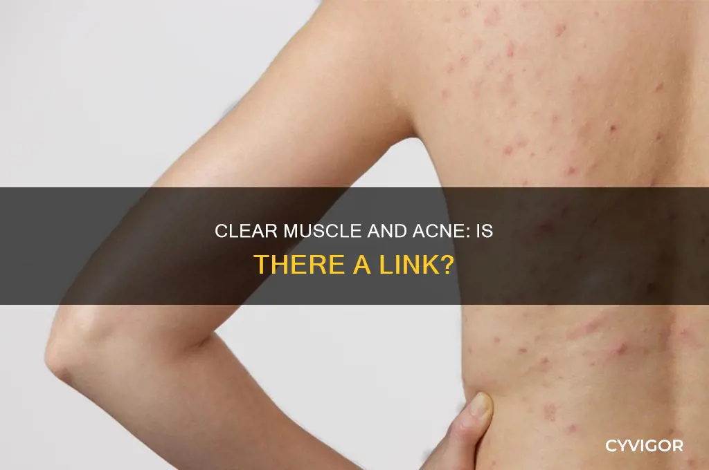 Clear Muscle And Acne: Is There A Link? | CyVigor