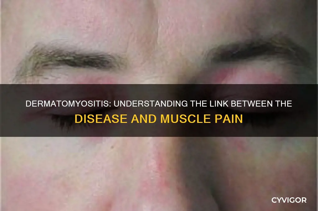 Dermatomyositis: Understanding The Link Between The Disease And Muscle ...