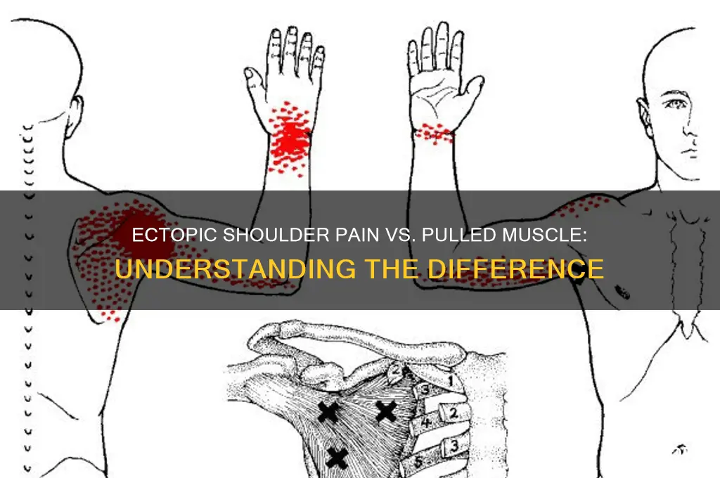 Ectopic Shoulder Pain Vs. Pulled Muscle: Understanding The Difference ...