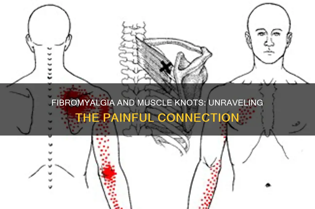 Fibromyalgia And Muscle Knots: Unraveling The Painful Connection | CyVigor
