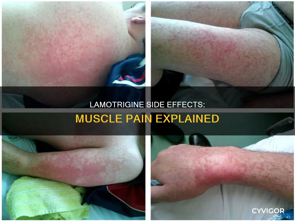 Lamotrigine Side Effects: Muscle Pain Explained | CyVigor