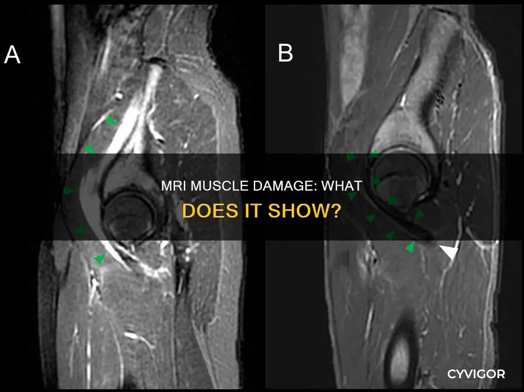 Mri Muscle Damage: What Does It Show? | CyVigor