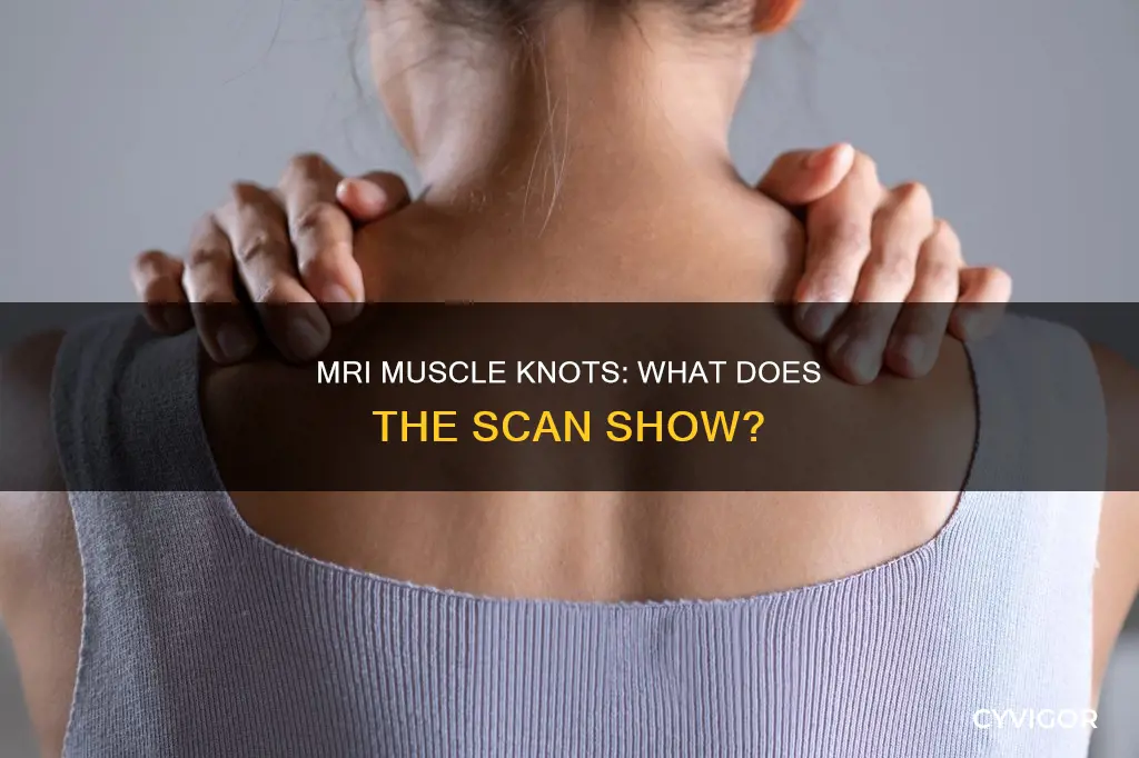 Mri Muscle Knots: What Does The Scan Show? | CyVigor