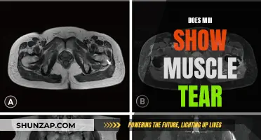 Mri Scans: Muscle Problems And What They Show | CyVigor