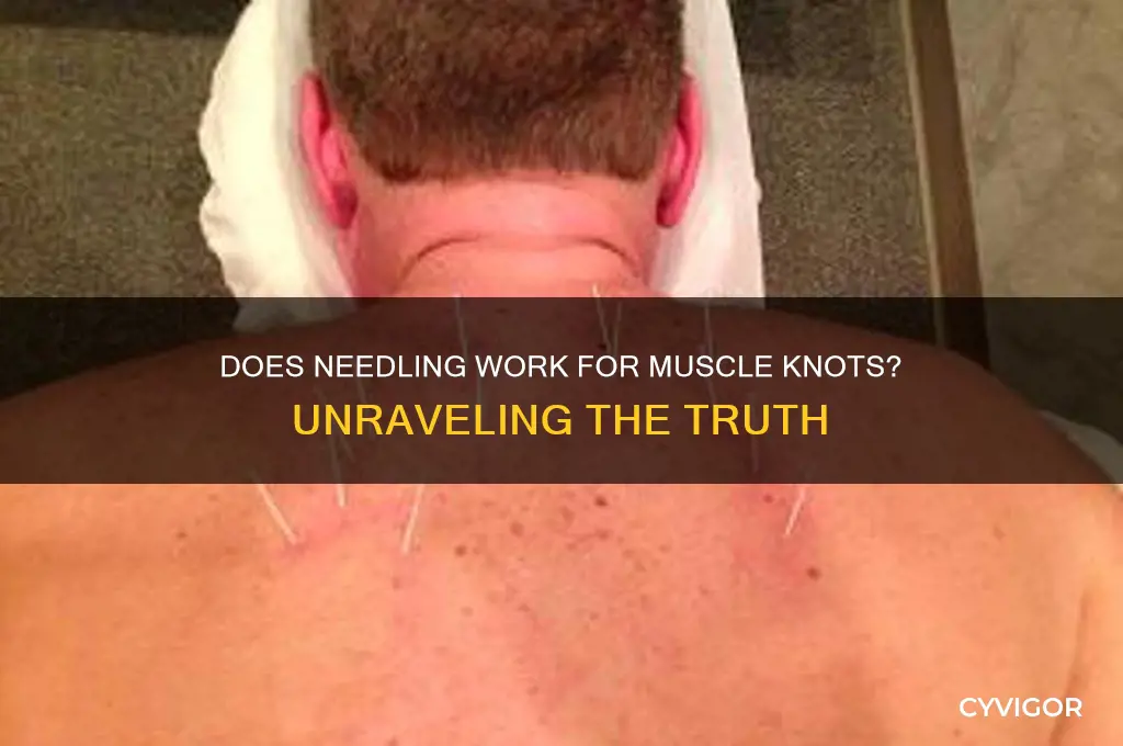 Does Needling Work For Muscle Knots? Unraveling The Truth | CyVigor