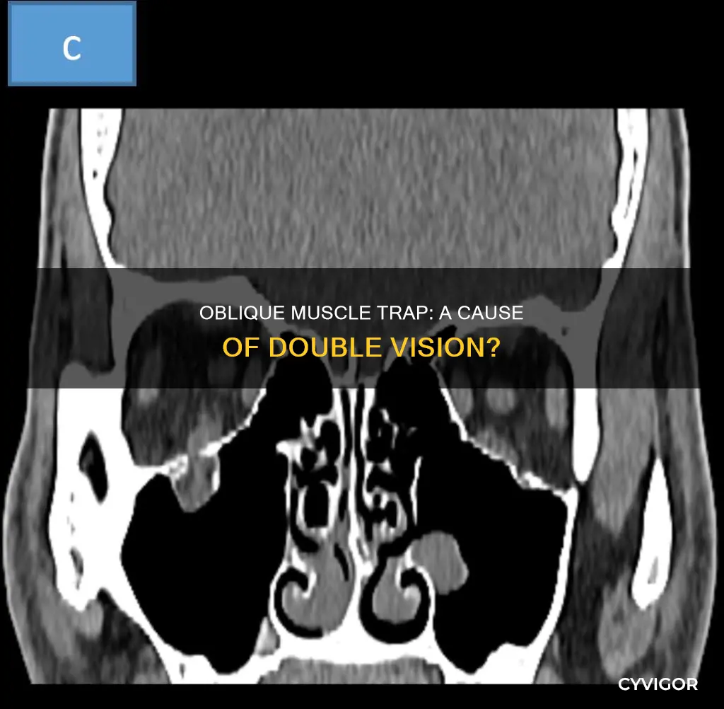 Oblique Muscle Trap: A Cause Of Double Vision? | CyVigor