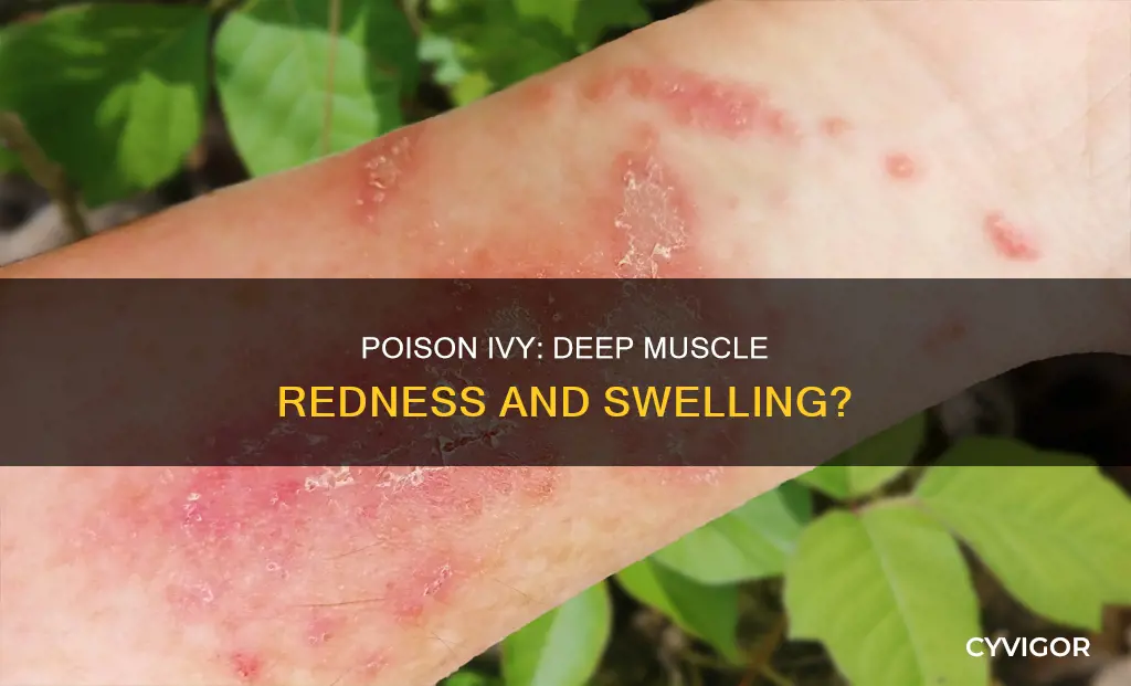 Poison Ivy: Deep Muscle Redness And Swelling? | CyVigor