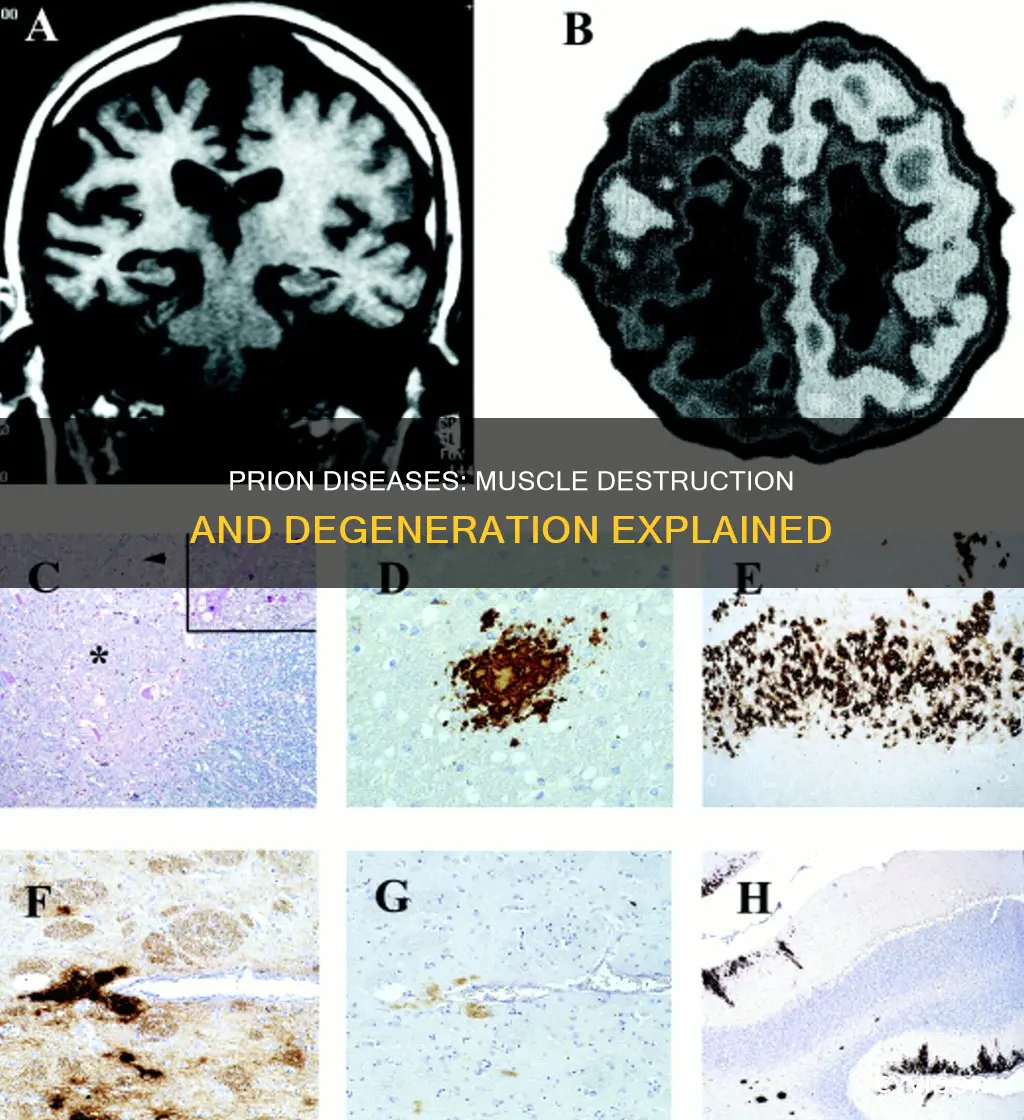Prion Diseases: Muscle Destruction And Degeneration Explained | CyVigor