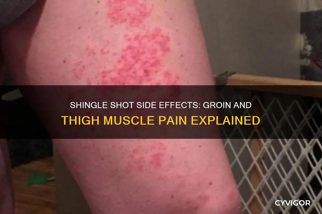 Shingle Shot Side Effects: Groin And Thigh Muscle Pain Explained | CyVigor