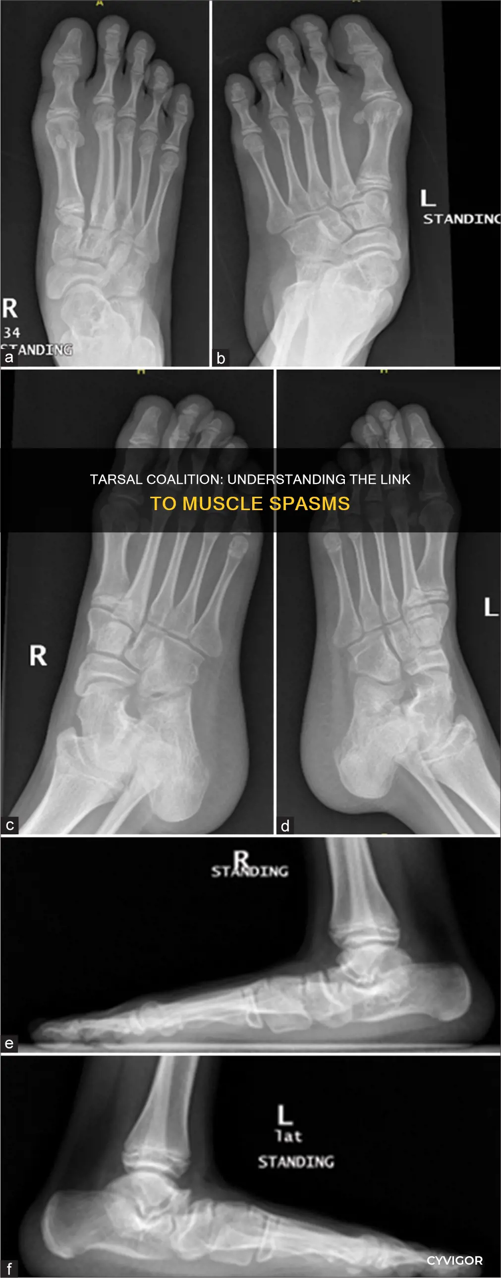 Tarsal Coalition: Understanding The Link To Muscle Spasms | CyVigor