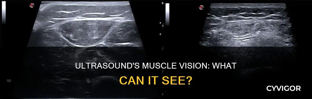 Ultrasound's Muscle Vision: What Can It See? | CyVigor