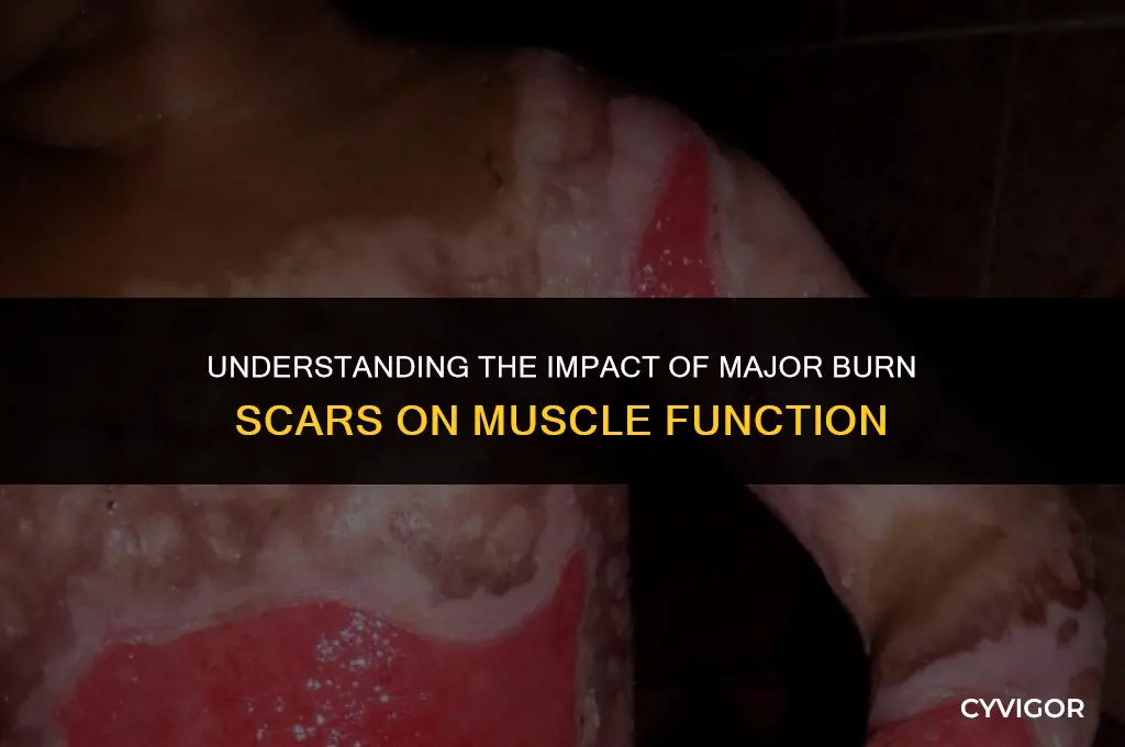 Understanding The Impact Of Major Burn Scars On Muscle Function | CyVigor