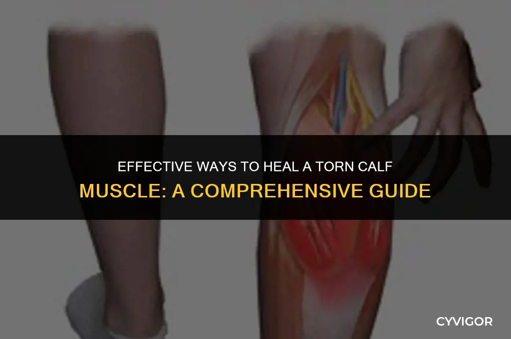 Effective Ways To Heal A Torn Calf Muscle: A Comprehensive Guide | CyVigor