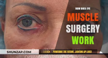 Understanding Eye Muscle Tie Surgery: Procedure, Benefits, And Recovery ...