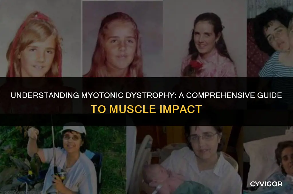 Understanding Myotonic Dystrophy: A Comprehensive Guide To Muscle ...