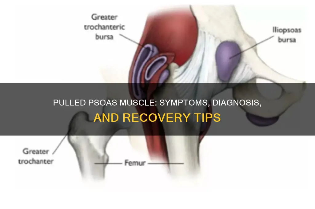 Pulled Psoas Muscle: Symptoms, Diagnosis, And Recovery Tips | CyVigor
